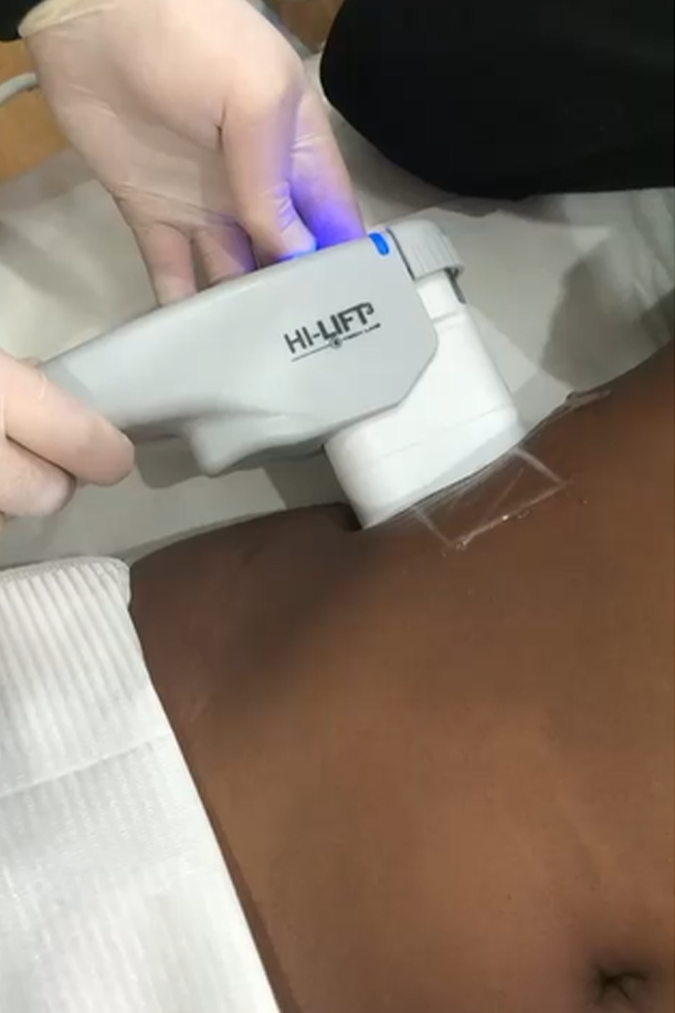 HIFU Body Contouring and Sculpting Treatment – Shane Cooper